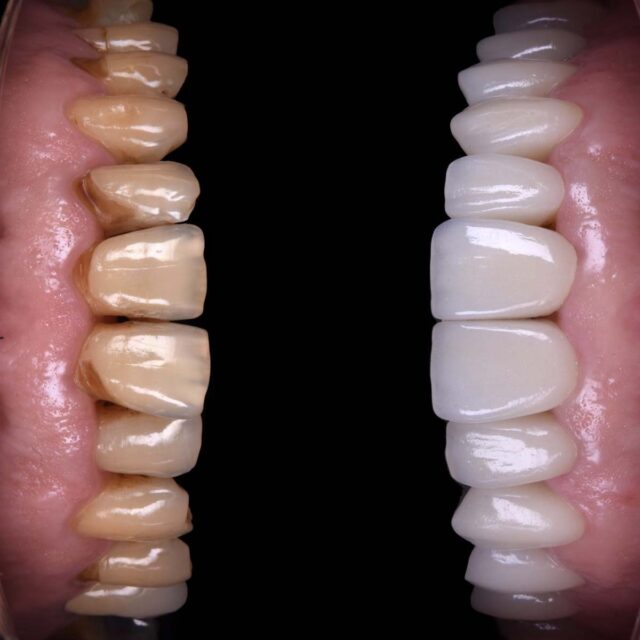 E-Max Crowns – DMC DENTAL SERVICES